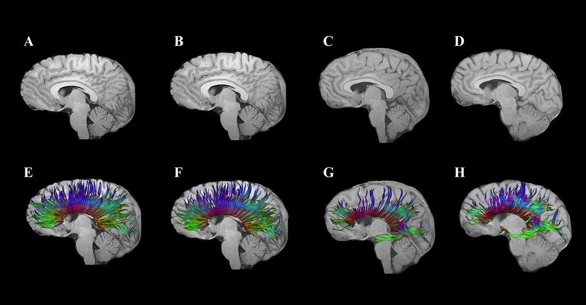 The dangers of traumatic brain injuries in contact sport